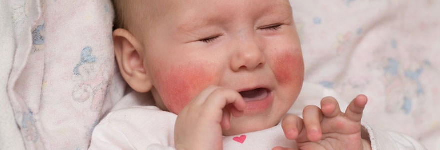 Comment traiter naturellement l’eczéma du nourrisson